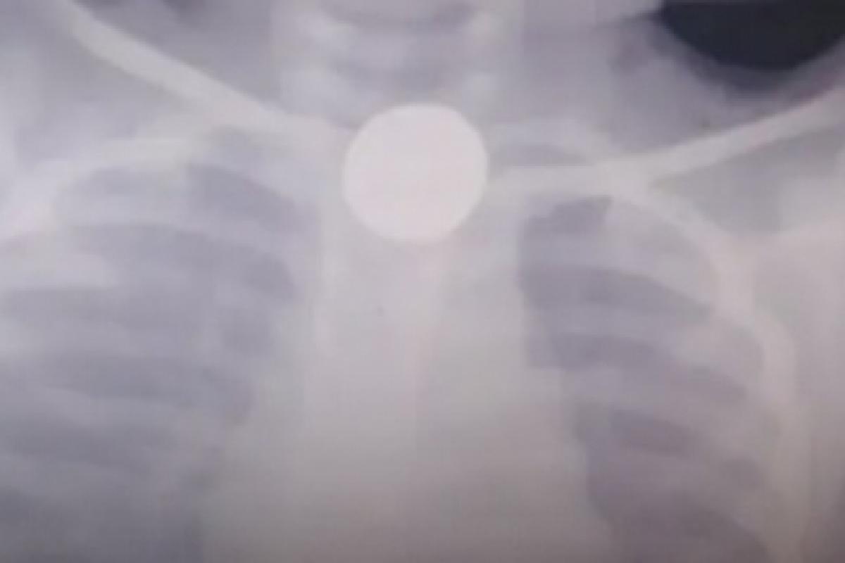 Menino de 2 anos morre engasgado com moeda de 50 centavos